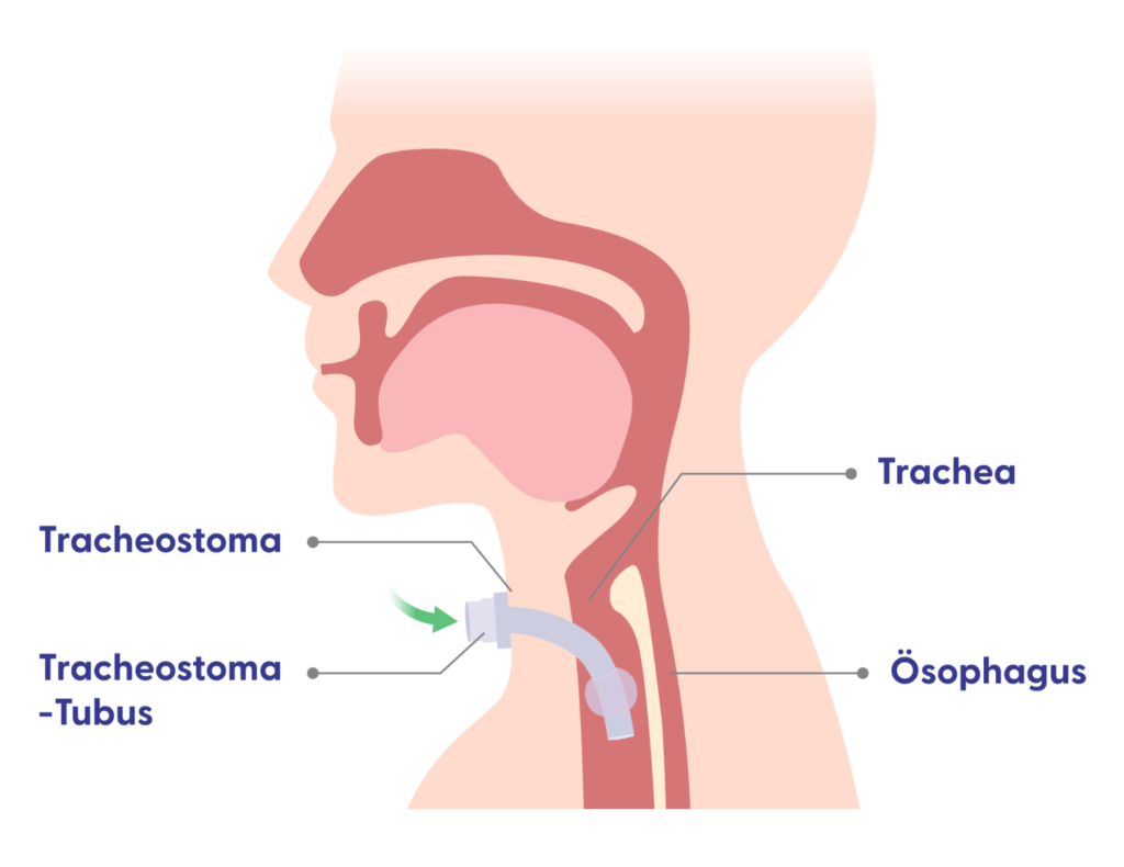 Tracheostoma